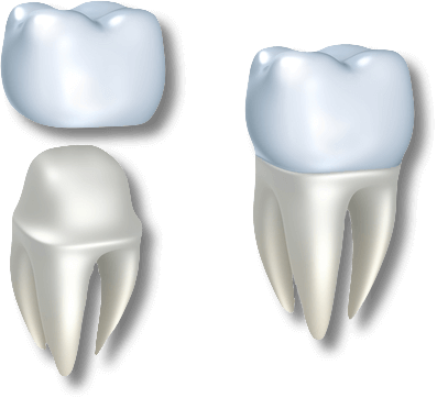 Dental Crowns in El Paso TX | Best Teeth Crowns | Sol Dental